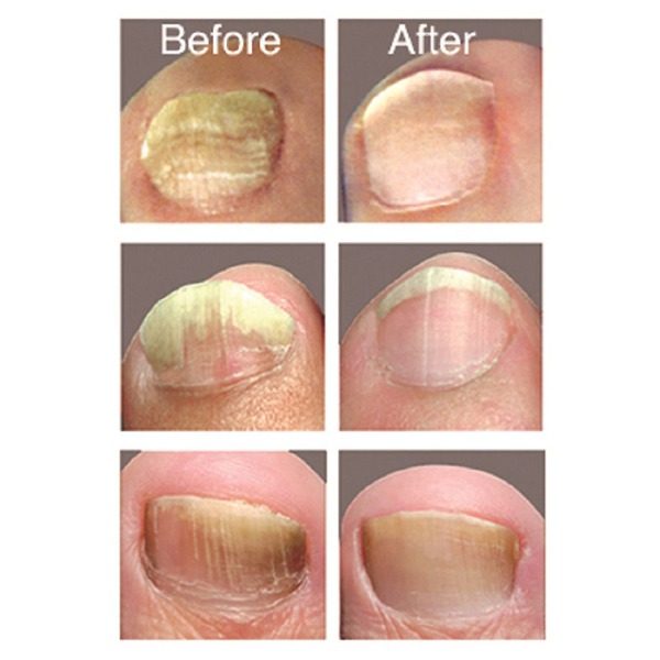 Nonyx NONYX Fungal Nail Clarifying Gel - 1Source