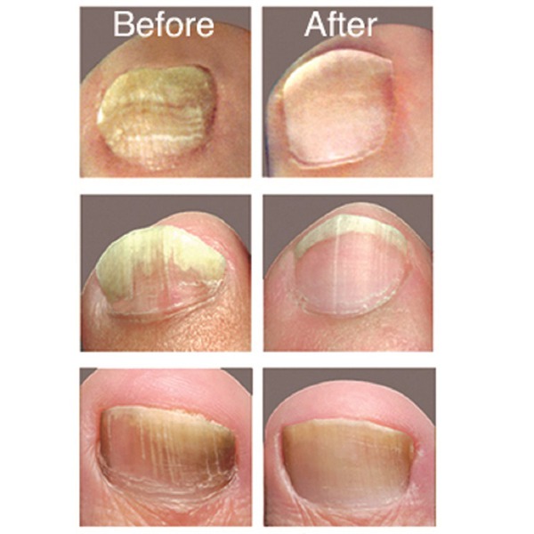 Nonyx NONYX Fungal Nail Clarifying Gel - 1Source