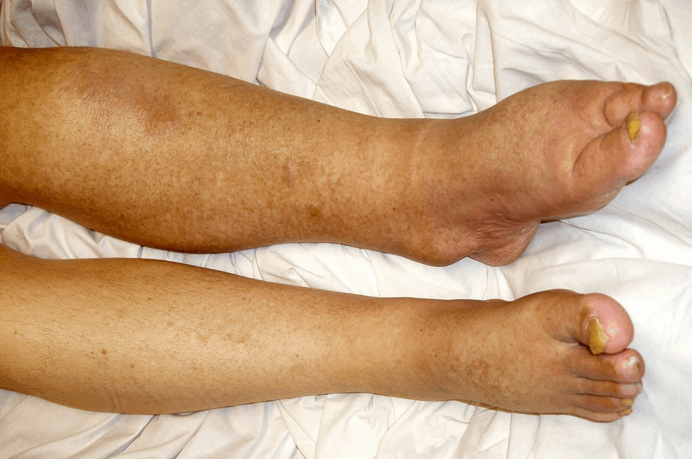 Edema And Swelling Problems Dherbs Dherbs News Alternative Medicine