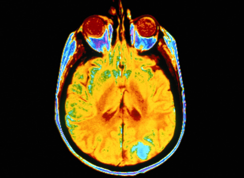 Dark Spots On Mri