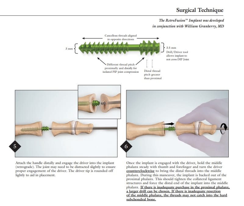 Bone screw with opposing threads - photo - HomemadeTools.net